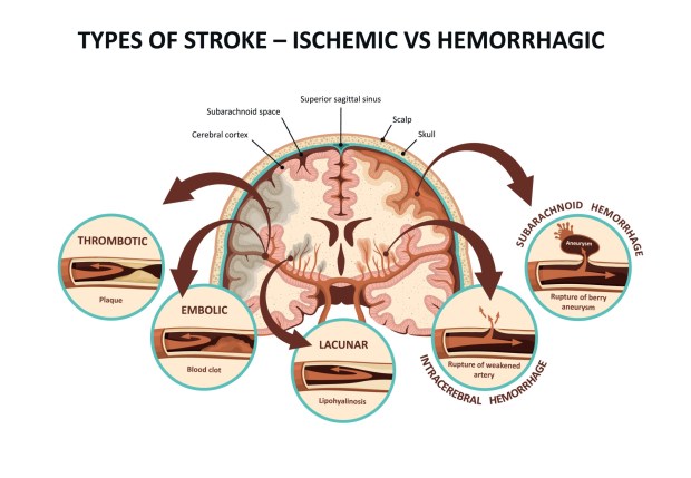 Herseninfarct & hersenbloeding